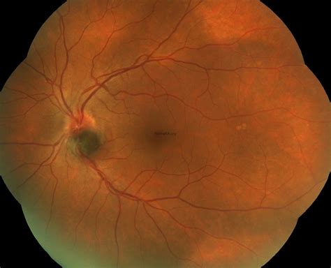 Optic Disc Melanocytoma Retinara
