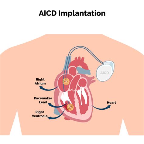 Aicd Implantation Treatians