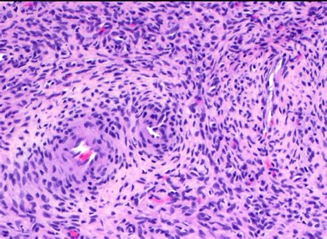 Jerad 45 Yo Man Lower Leg Subcutaneous Nodule Clinical Rule Out Cyst Nope Answer