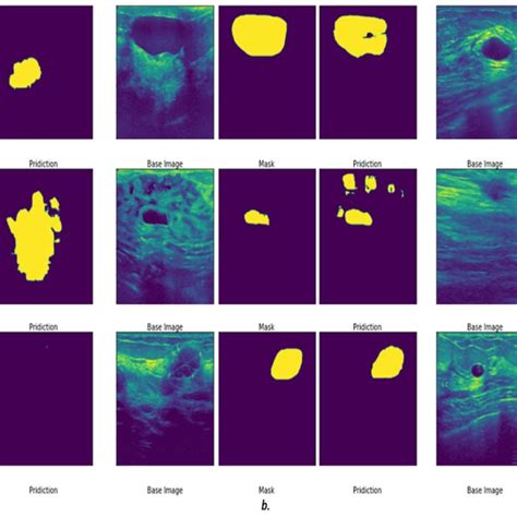 preliminary results indicate a promising outcome of automated breast