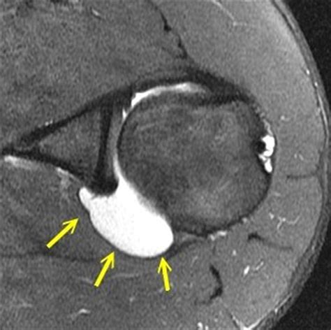 Multidirectional Shoulder Instability Mdi Shoulder And Elbow Orthobullets