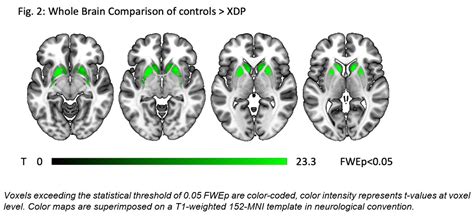 Striatal Neurodegeneration In The Presymptomatic Phase Of X Linked