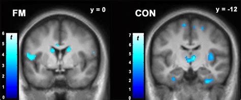 voxel wise results from the linear regression between fal blbp and