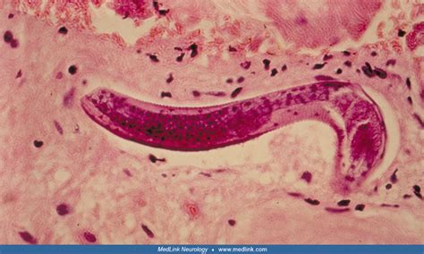 Trichinosis Medlink Neurology