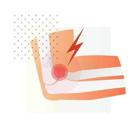 Lateral Epicondylitis Known As Tennis Elbow Stock Illustration Stock