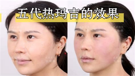 【皮肤医生张琳琳】五代热玛吉全面部效果即刻～ Youtube