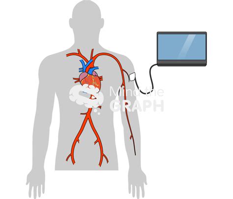 Central Aortic Pressure Measurement Body