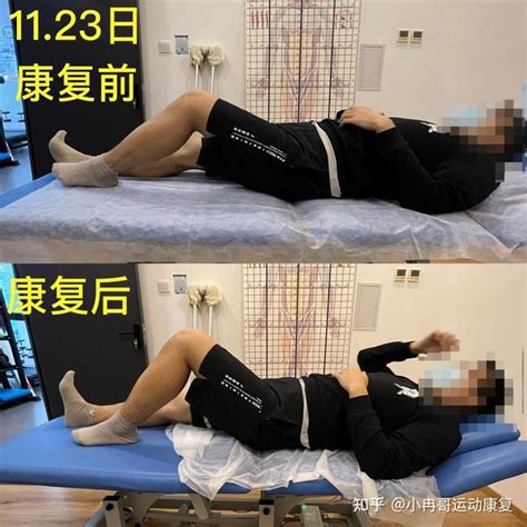 案例分享前叉术后合并半月板 知乎