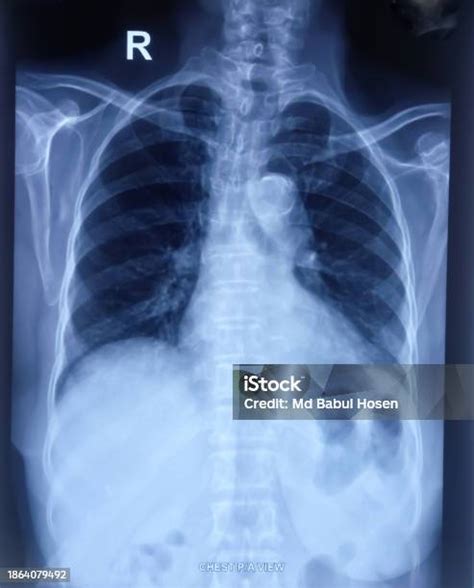 Pneumonitis Tampilan Pa Pneumonitis Hipersensitivitas Foto Stok Unduh