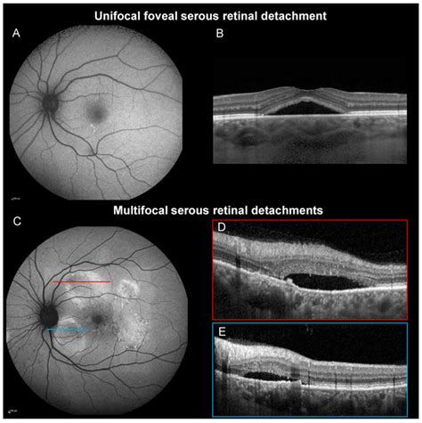 Ab Central Serous Chorioretinopathy Cscr With A Unifocal Macular