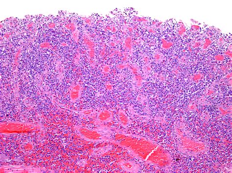 Pathology Outlines Inflammatory Polyp
