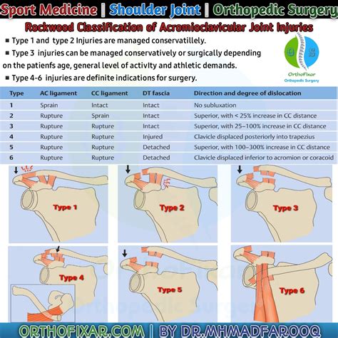Rockwood Classification Of Acromioclavicular Joint Acromioclavicular