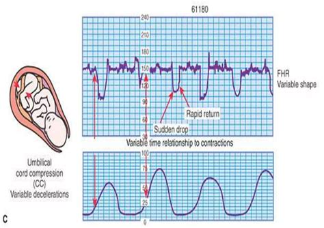 Fetal Cardiotocograph Ctgpptx
