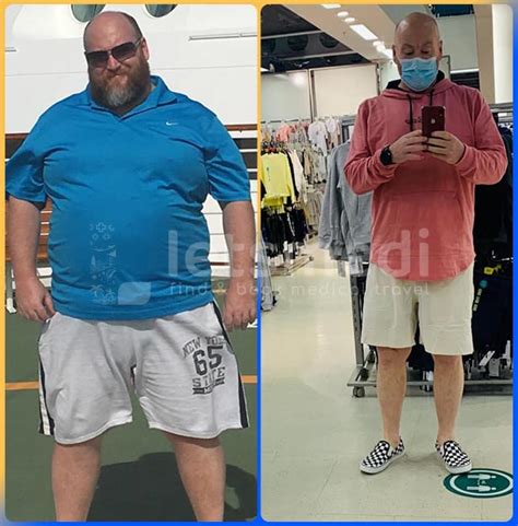 Gastric Bypass Before And After Letsmedi