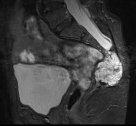 Unc Neurosurgery On Linkedin 72 Year Old Patient Diagnosed With Sacral