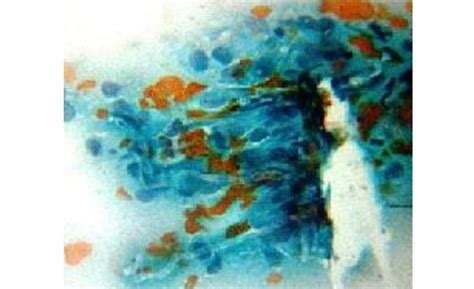The Cytoplasm Of Multinucleated Giant Cells And Histiocytes Showed