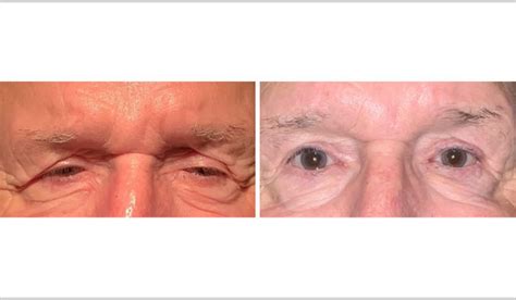 External Levator Advancement With Browpexy Beach Eye Care Lasik