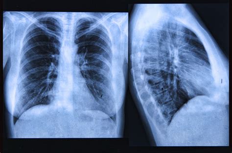 Cystic Fibrosis Gene Therapy Shows Promising Results For Lung Function