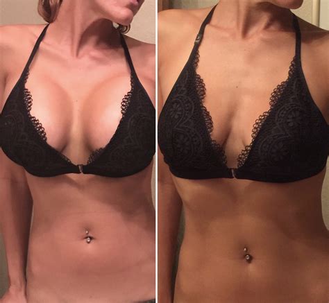 34c Implants
