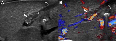 Portal Vein Thrombosis And Food Protein Induced Allergic Proctocolitis In A Premature Newborn