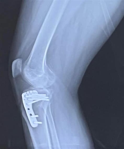 Lateral Tibial Plateau Bone Fractured By A Car Impact As A Pedestrian