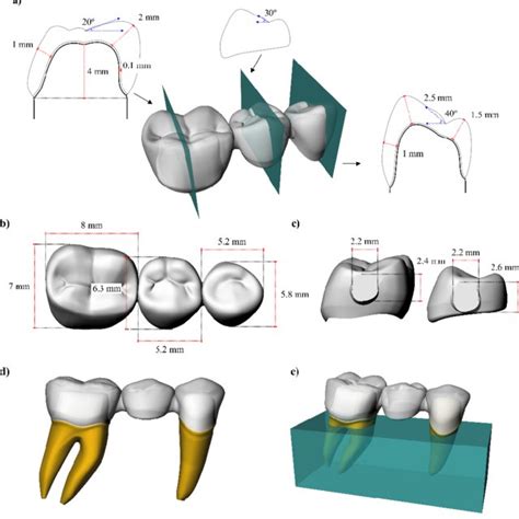Onlay Preparation Design For Endodontically Treated Mandibular Molar