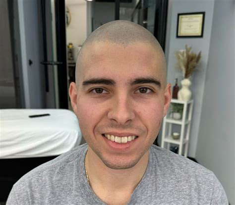 Hair And Scalp Analysis For Hair Loss Greensboro Nc Scalp Micro Pro Clinic