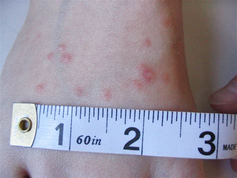 Chigger Bites What They Look Like Prevention Treatment The Healthy