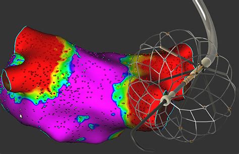 Medtronic Boston Scientific Abbott And Jandj Pfa Catheter Shapes