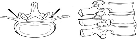 Transpedicular Decompression And Pedicle Subtraction Osteoto Spine