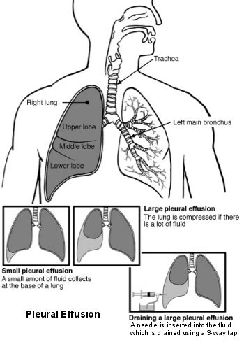 Pleural Effusion Symptoms Causes And Treatment