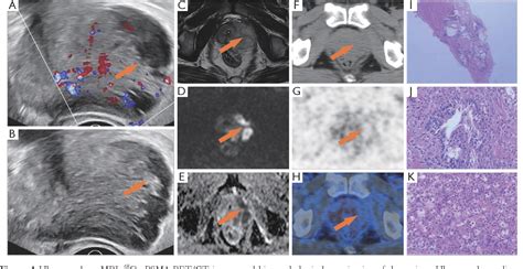 Figure 1 From False Positive Mpmri And True Negative 68ga Psma Petct