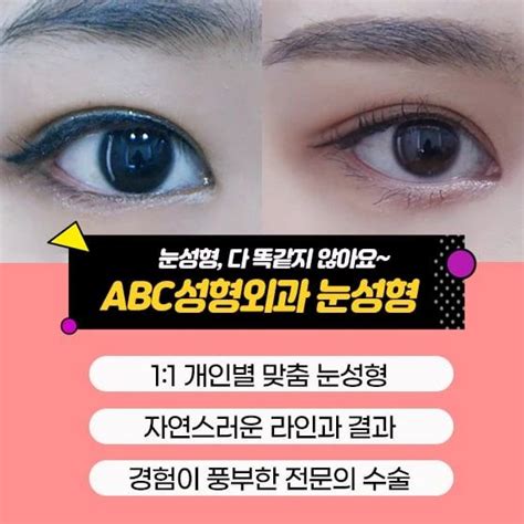 Abc 성형외과 Abc성형외과에서 이미지 Upup Abc 눈and코성형은 라인이 예쁘니까 ★11맞춤형