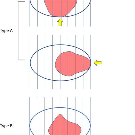 Type Of Horizontal Margin Status Type A Was Defined As Cancer Exposed