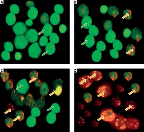 Antitumor And Apoptotic Effects Of 5 Methoxypsoralen In U87mg Human