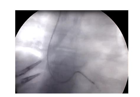 Final Fluoroscopic Image After Repositioning Of Pacemaker Lead