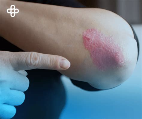 Stem Cells And Psoriasis Eternal