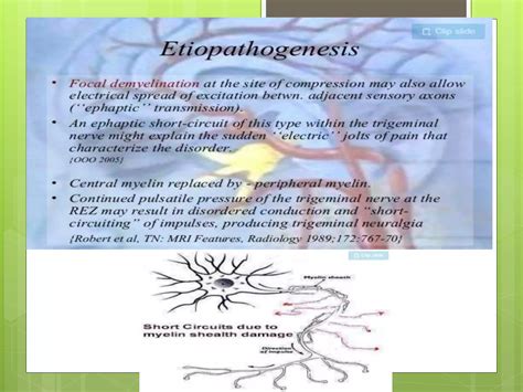 Trigeminal Neuralgia PPTX