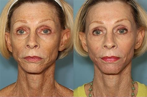 Active Fx Laser Before And After Photos Grossman Dermatology
