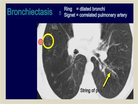 Presentation1 Pptx Radiological Imaging Of Bronchiectasis