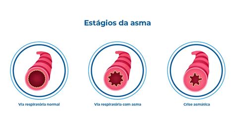 Sintomas De Asma Em Criancas Vocêsabia A Asma Afeta Tanto Adultos
