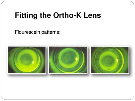 Ppt The Orthokeratolgy Company Powerpoint Presentation Free Download