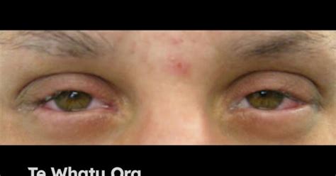 Sjs Ten Ocular Image