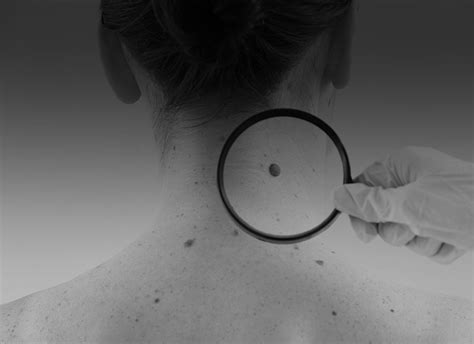 Lumps Bumps And Moles Removal Brisbane Skin Confidence