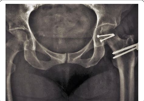 Follow Up Radiograph 2 Years Postoperatively Download Scientific Diagram