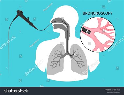 Mucus Plug Lungs Images Stock Photos Vectors Shutterstock