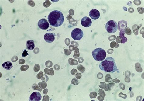 Bone Marrow Smear Showing Aplastic Anaemia Stock Image M1080377