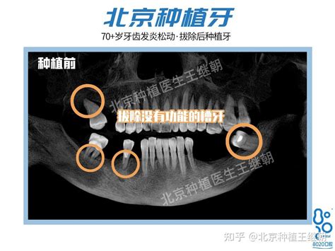北京种植牙案例70女性功能牙缺失，吃饭成难题，种植牙修复解决 知乎