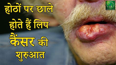 होठों पर छाले होते हैं लिप कैंसर ये लक्षण दिखें तो डॉक्टर को दिखाएं