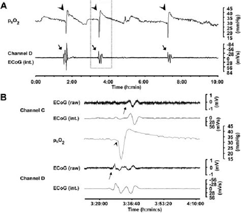 Coregistration Of Electrocorticography Ecog And Tissue Oxygen